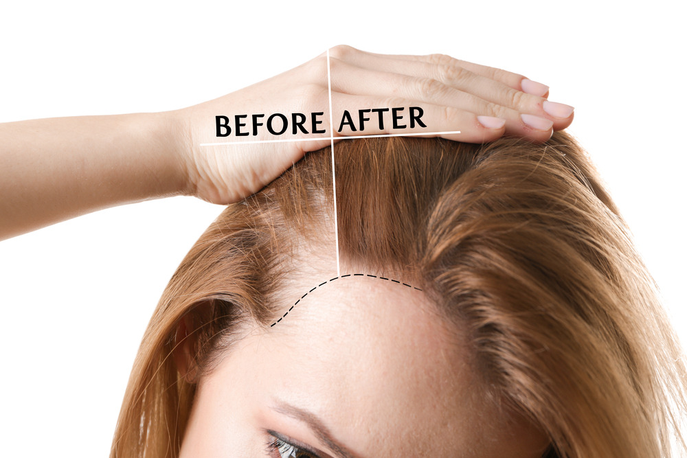 Stop Hair Loss: Causes & Natural Regrowth Tips | HAIRDEPOT