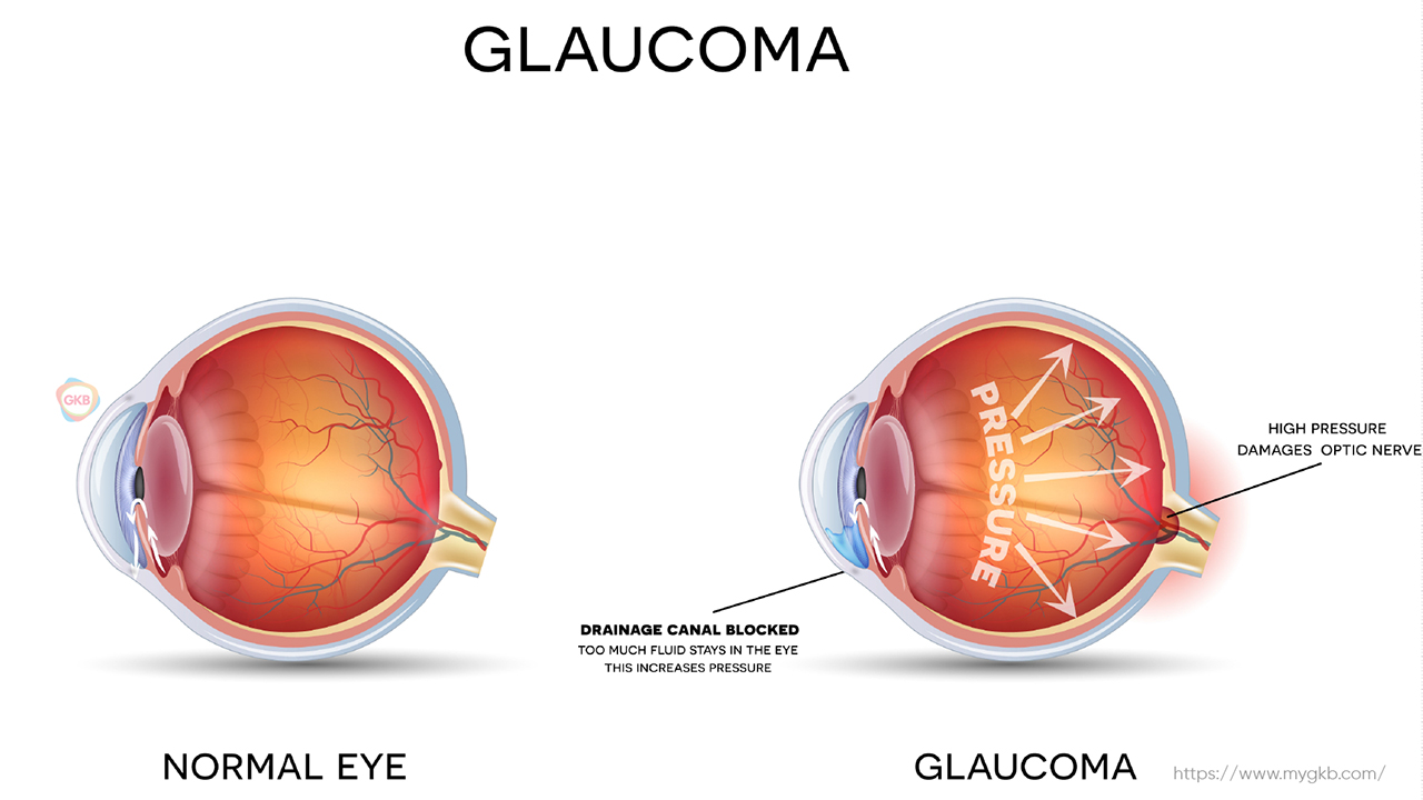 Can Glaucoma Cause Permanent Blindness? | GK Bio International
